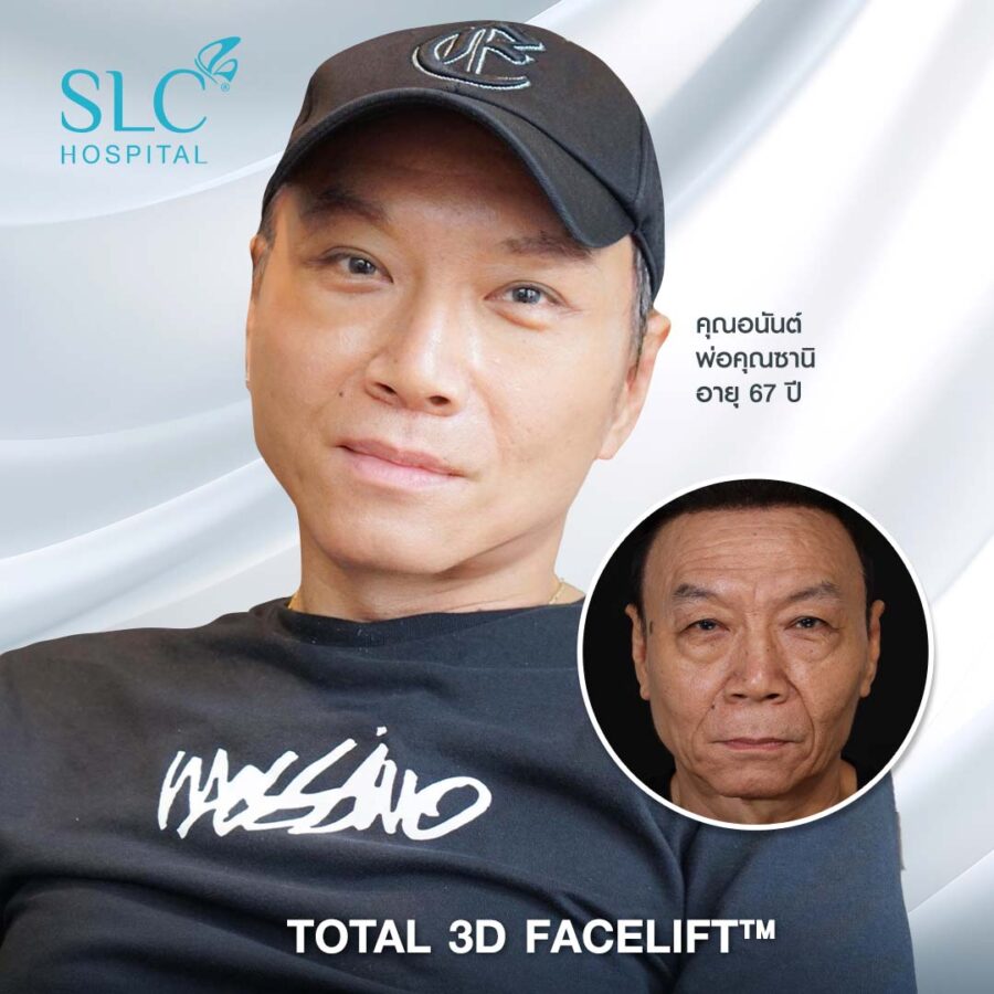 ศัลยกรรมดึงหน้า Total Facelift รื้อหน้าเก่า ย้อนวัยใส คืนวัยเฟรซ